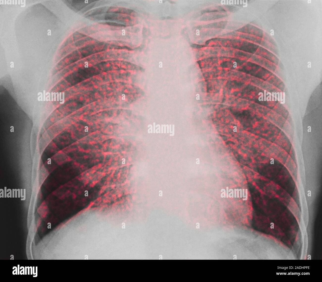 Sarcoidosis. Frontal coloured chest X-ray of the lungs of a patient ...
