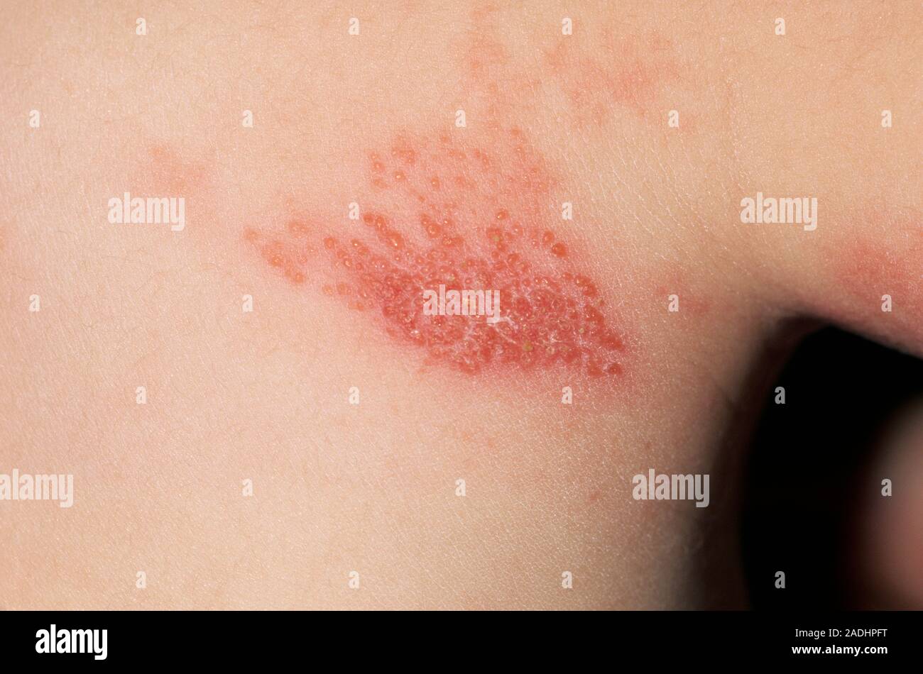 Shingles rash (C8 distribution) on the neck of a two-year-old girl ...