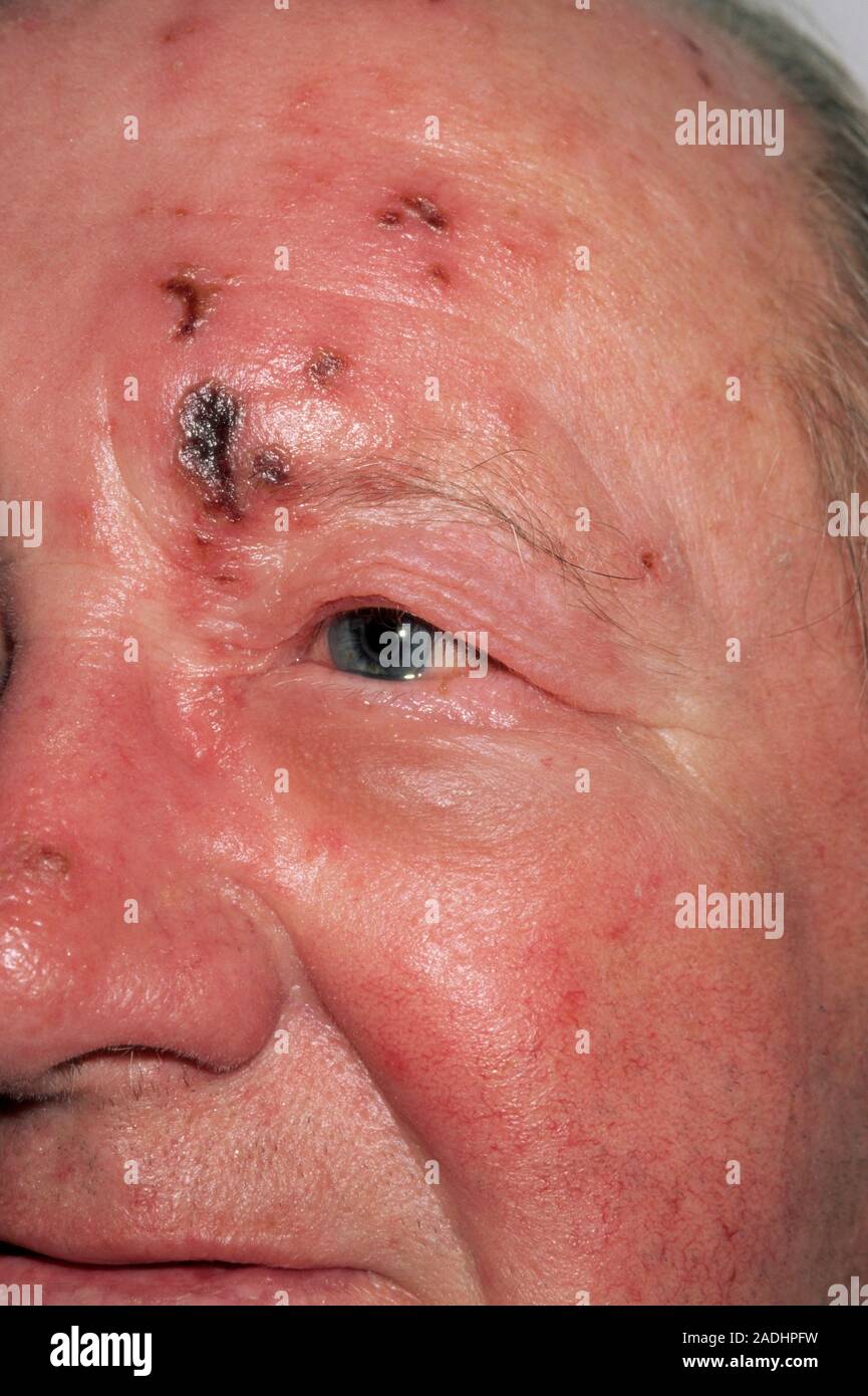 Shingles Rash V1 Distribution On The Forehead Of A 72 Year Old Man Shingles Herpes Zoster