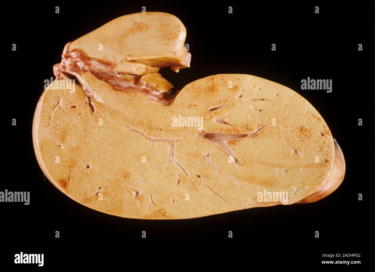 Fatty Liver Gross Specimen Of A Sectioned Liver With Steatosis Or