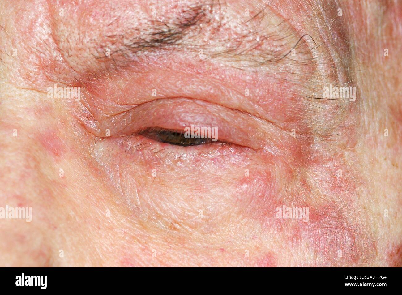 Shingles Rash Round The Eye Of A 76 Year Old Man Shingles Herpes Zoster Is The Result Of