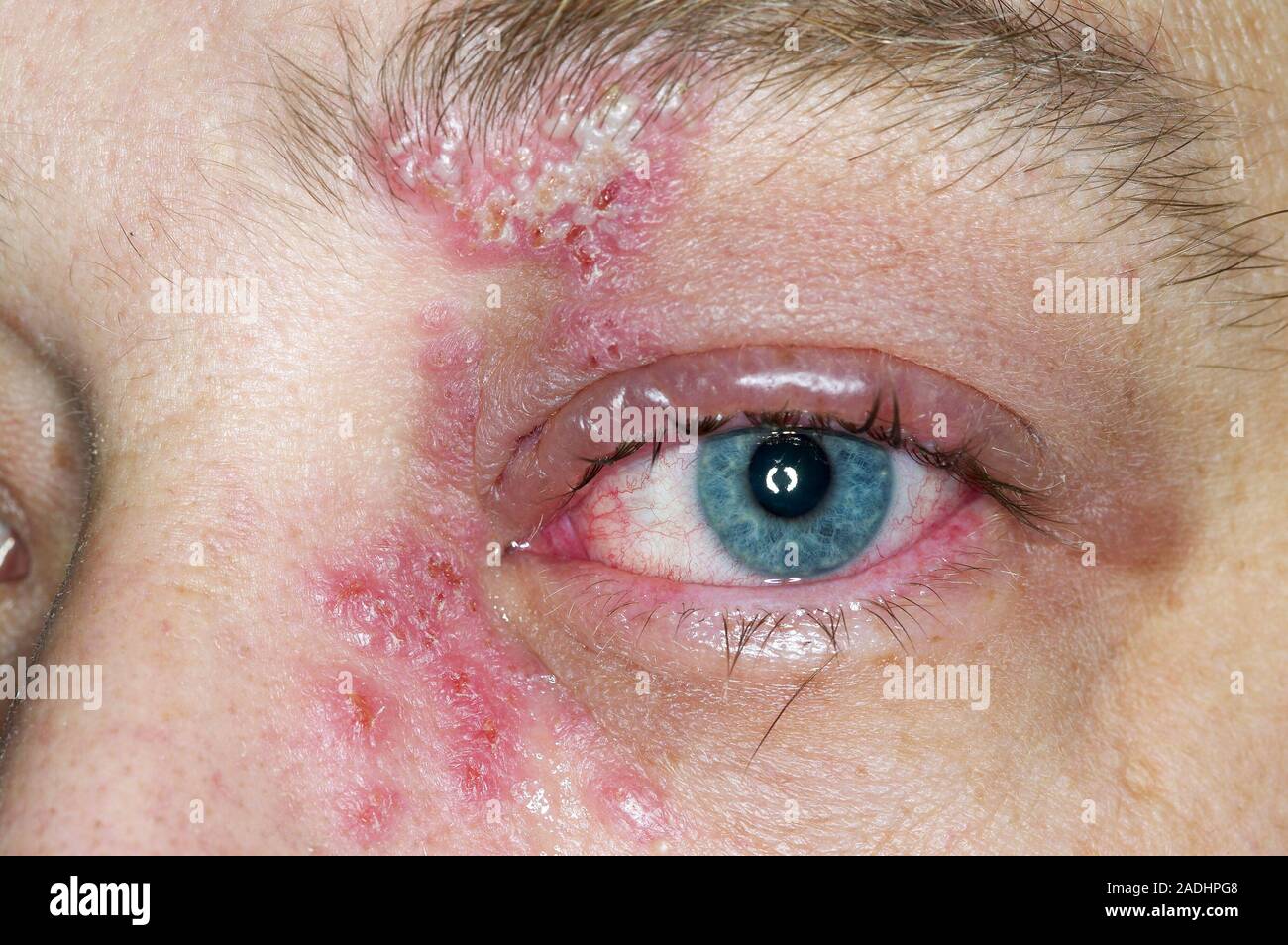 MODEL RELEASED. Shingles rash over a man's eye. Shingles is a disease ...