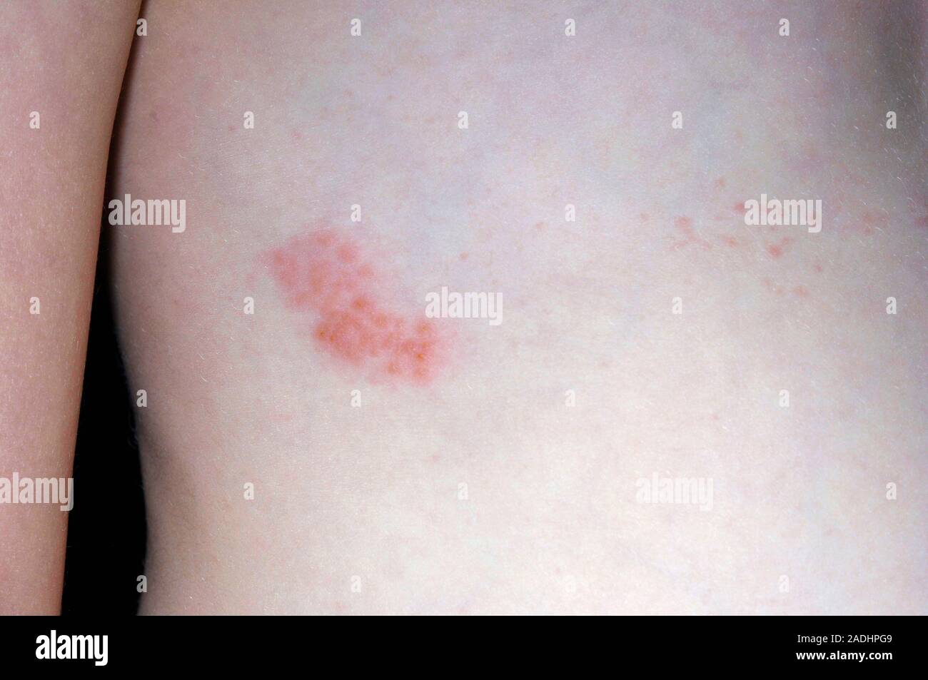 Shingles rash on the chest of a 4 year old boy. Shingles is a disease ...