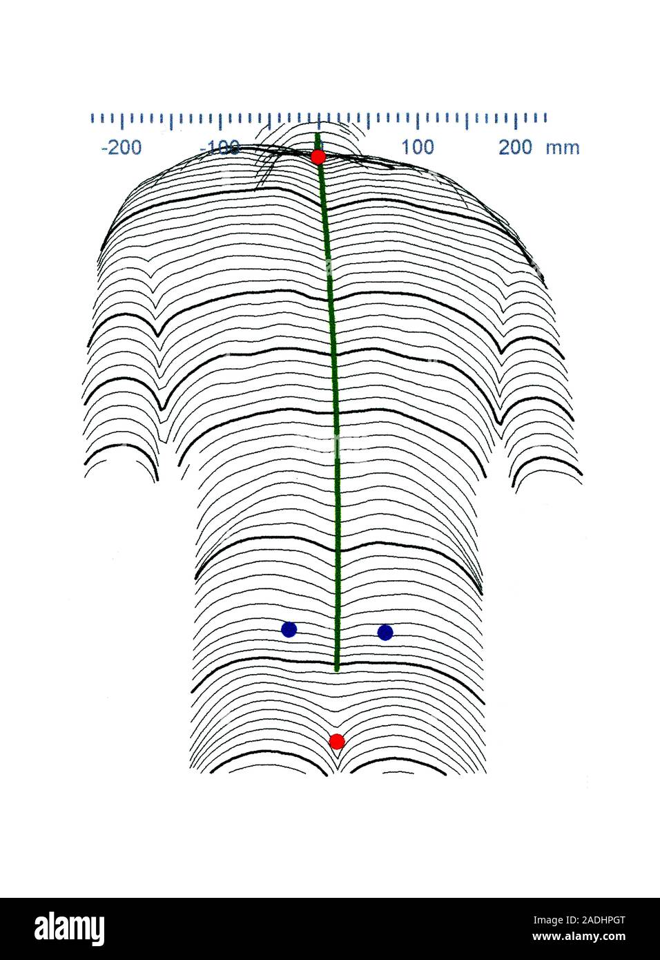 Scoliosis of the back, contour map. Computer artwork showing a dorsal ...