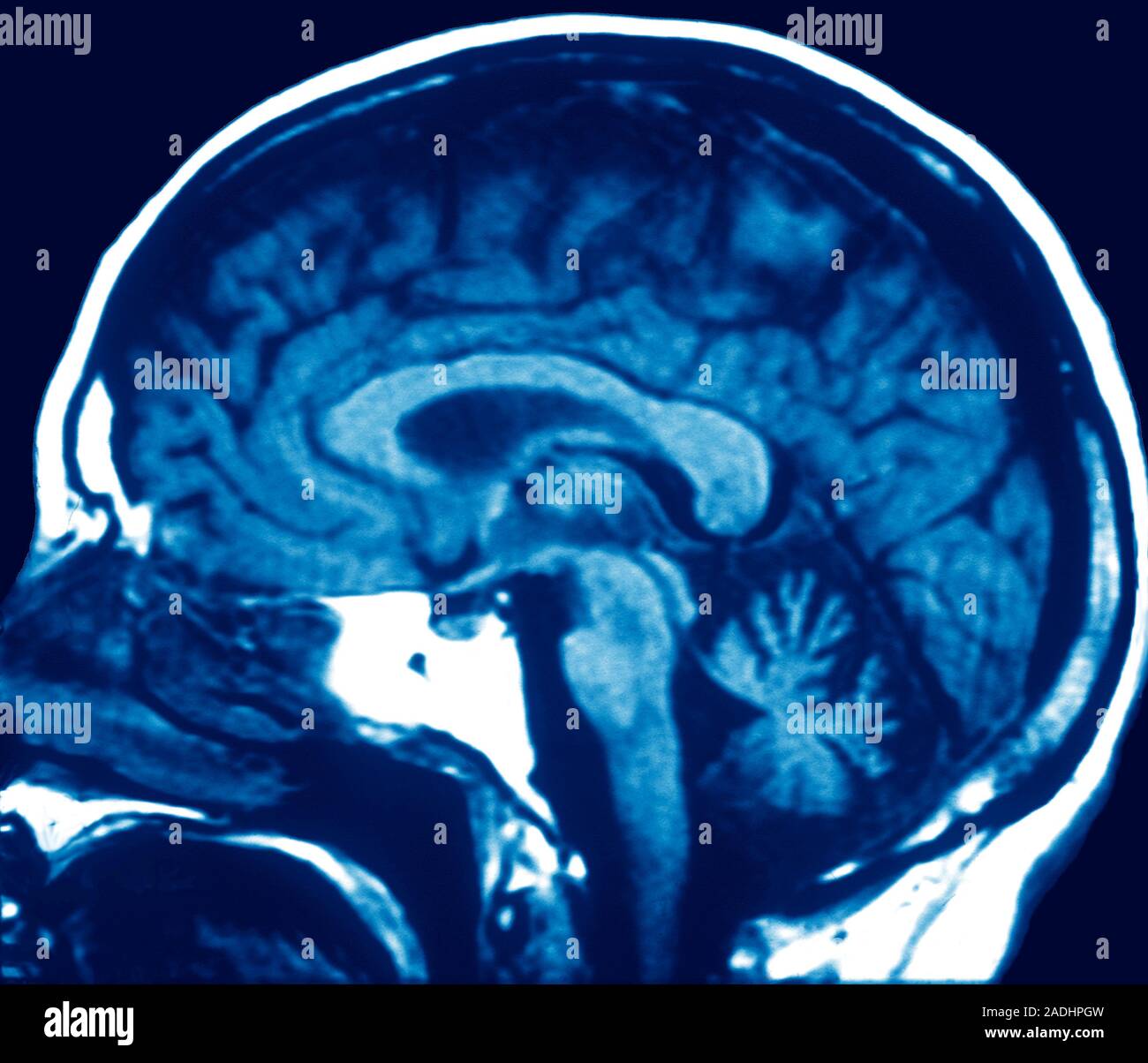 Progressive supranuclear palsy. Coloured magnetic resonance imaging ...