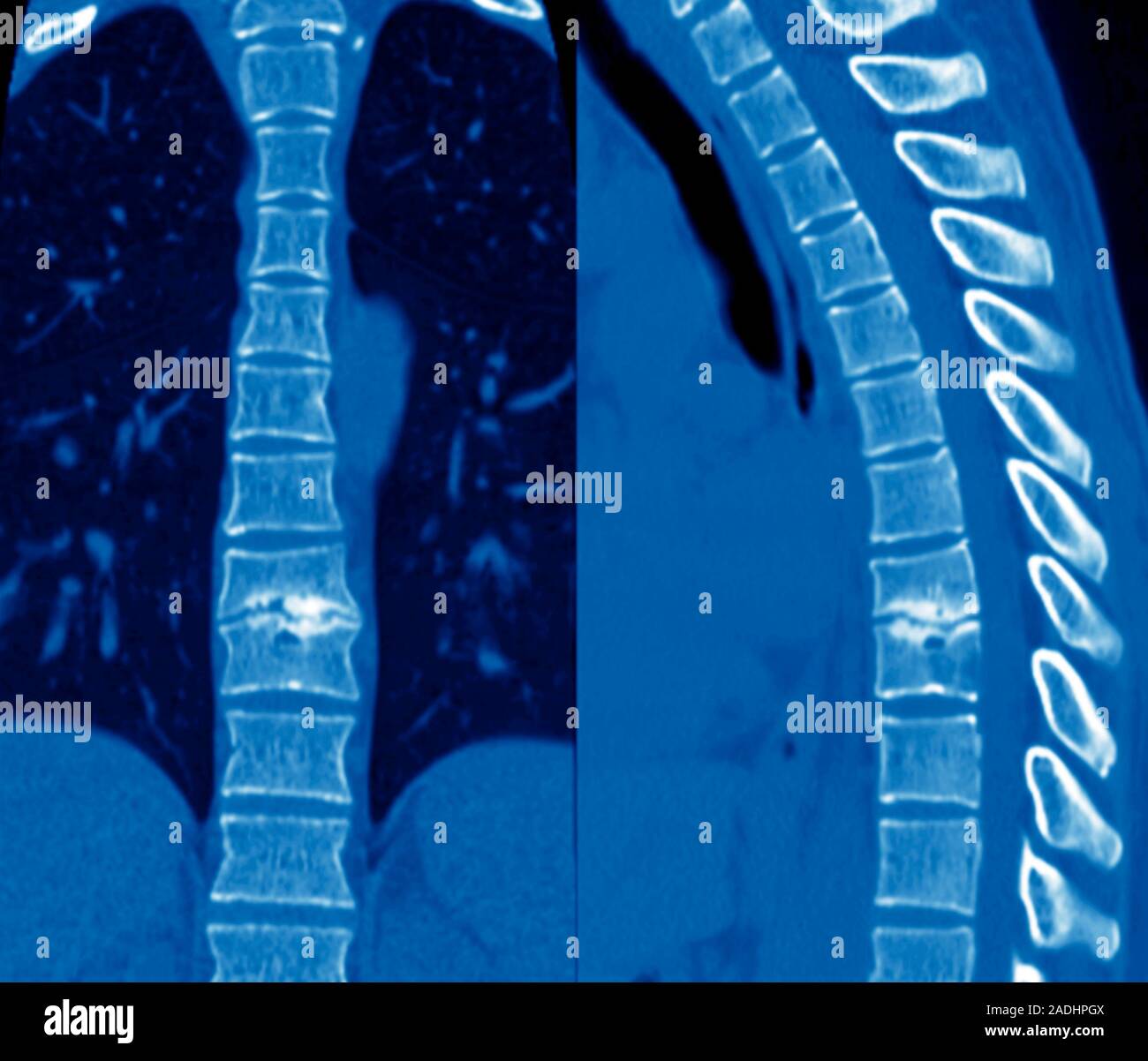 Infected spine. Coloured computed tomography (CT) scans of the spine of ...