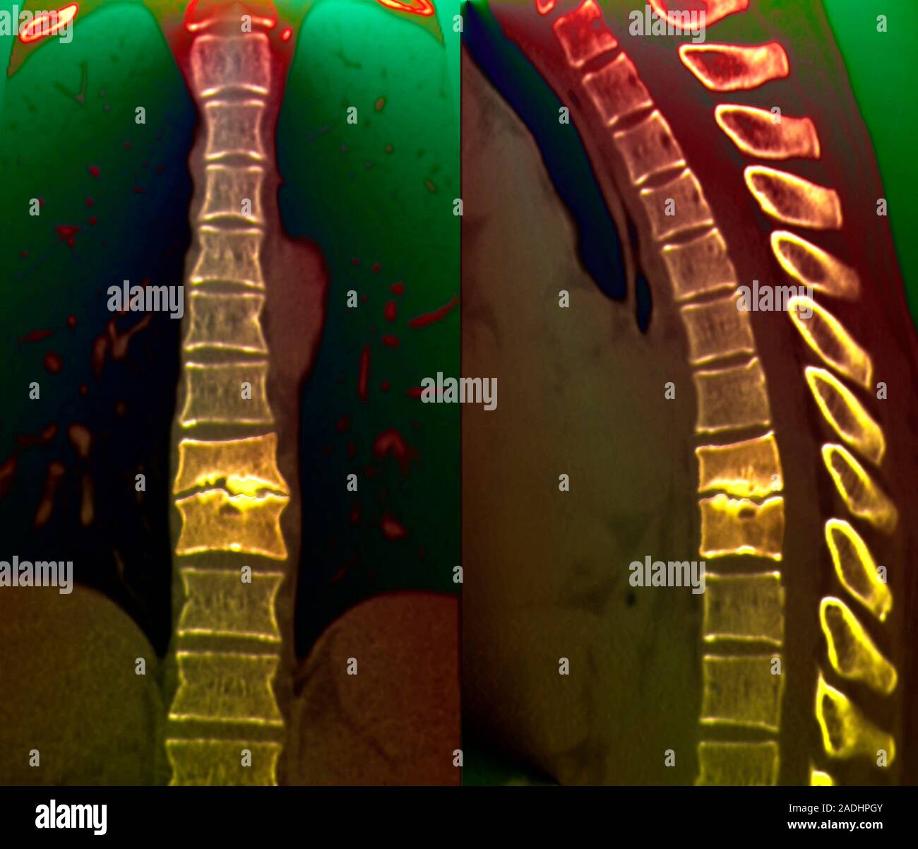 Infected spine. Coloured computed tomography (CT) scans of the spine of ...