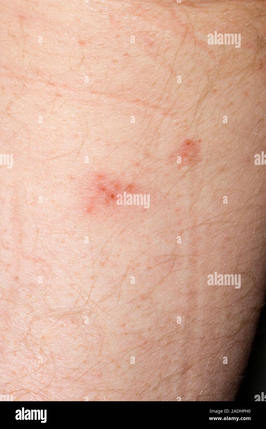 Shingles Rash On The Leg Of A 63 Year Old Man Shingles Is A Disease Caused By The Varicella