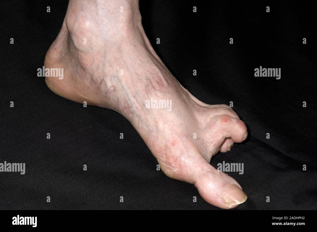 MODEL RELEASED. Scleroderma. Deformed foot of a 62 year old man with ...