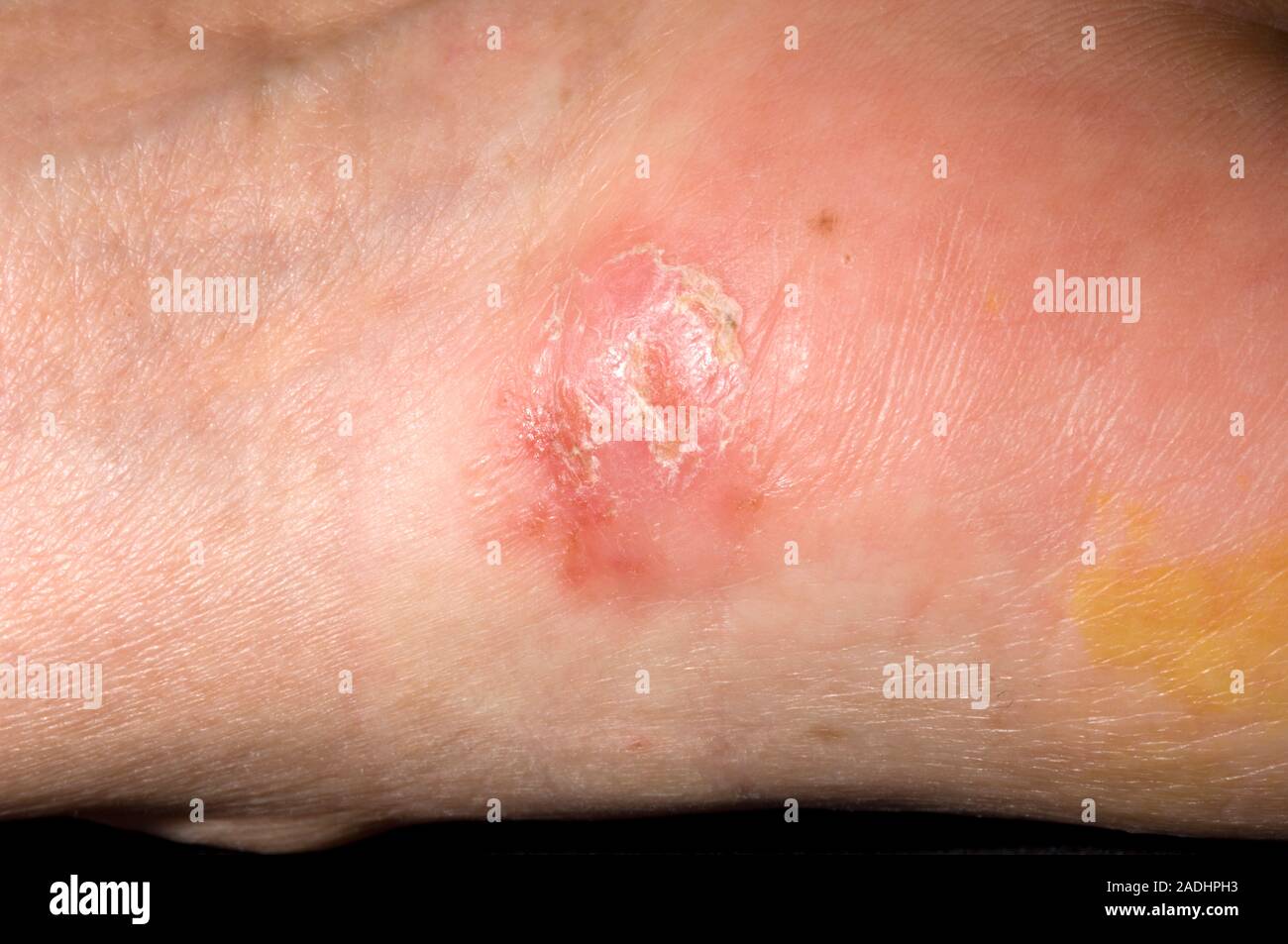 MODEL RELEASED. Bacterial infection. Inflamed area on a 56 year old ...
