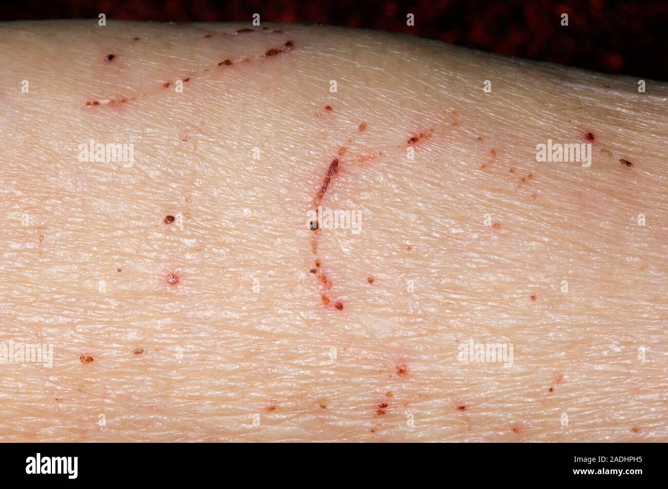 MODEL RELEASED. Scabies on arm. Scratches from scabies on the arm of a ...