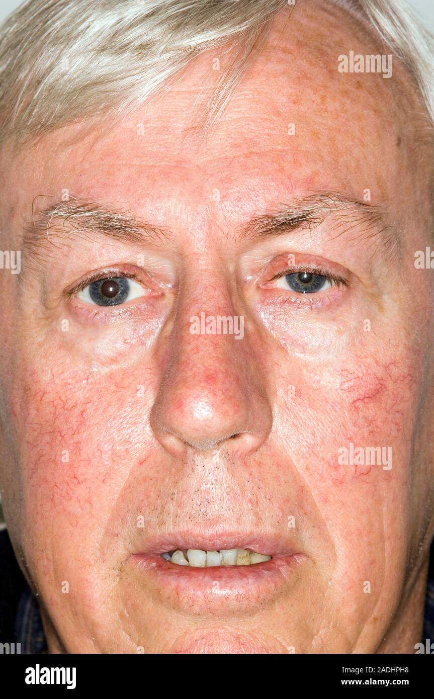 MODEL RELEASED. Sinusitis. 59-year-old man with acute sinusitis ...