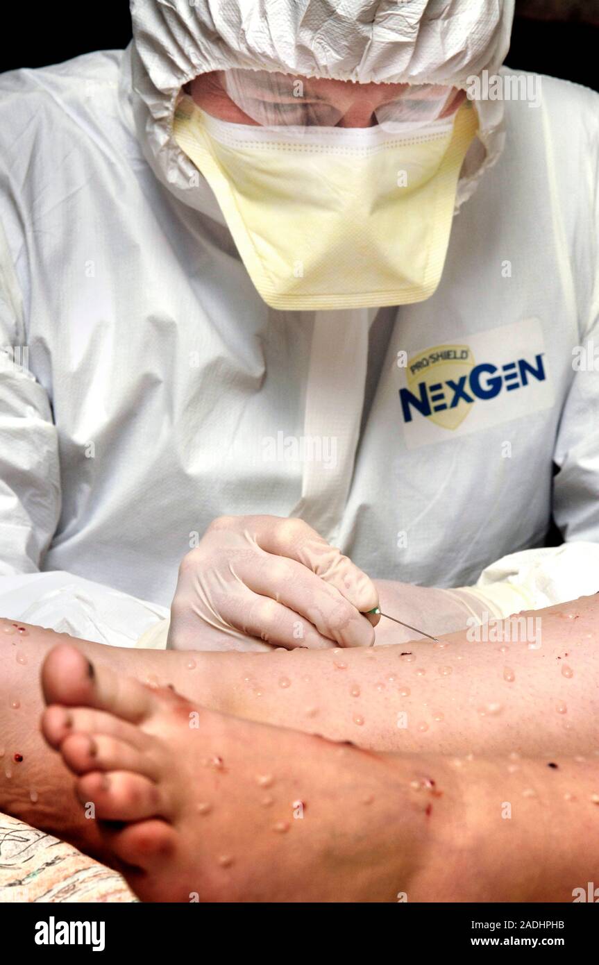 MODEL RELEASED. Smallpox infection. Simulation of a doctor taking a pus ...