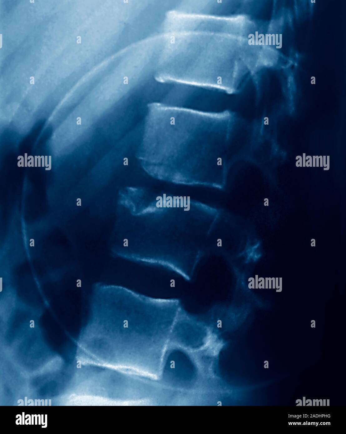 Scheuermann's disease. Coloured X-ray scan of the vertebrae (bones) of ...