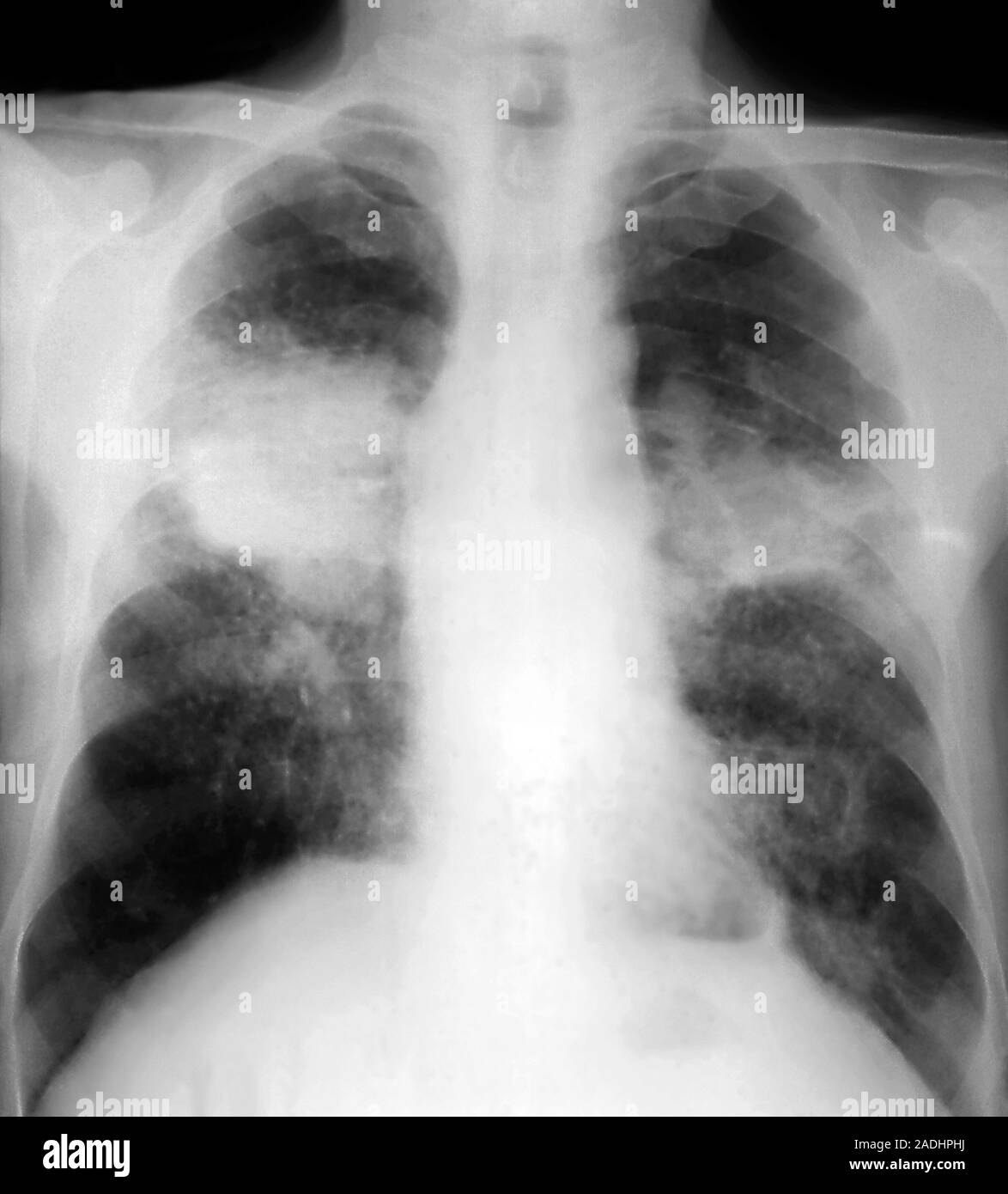 Silicotuberculosis of the lungs. X-ray of the lungs of a 61-year-old ...