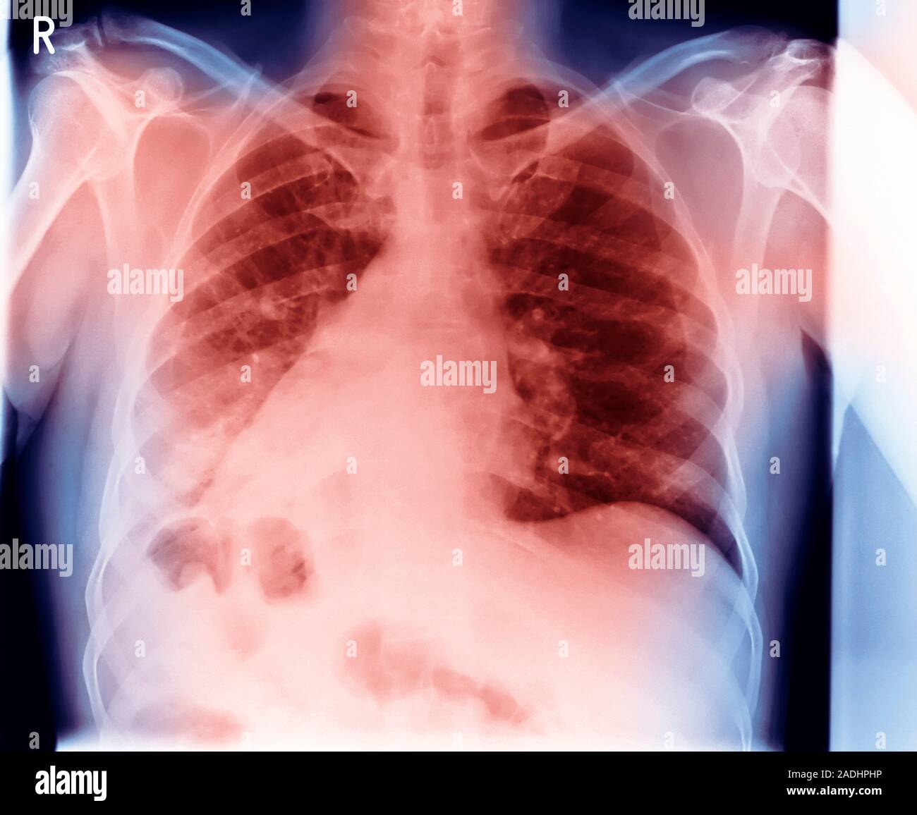 Reversed organs. Coloured frontal X-ray of a male with situs inversus ...