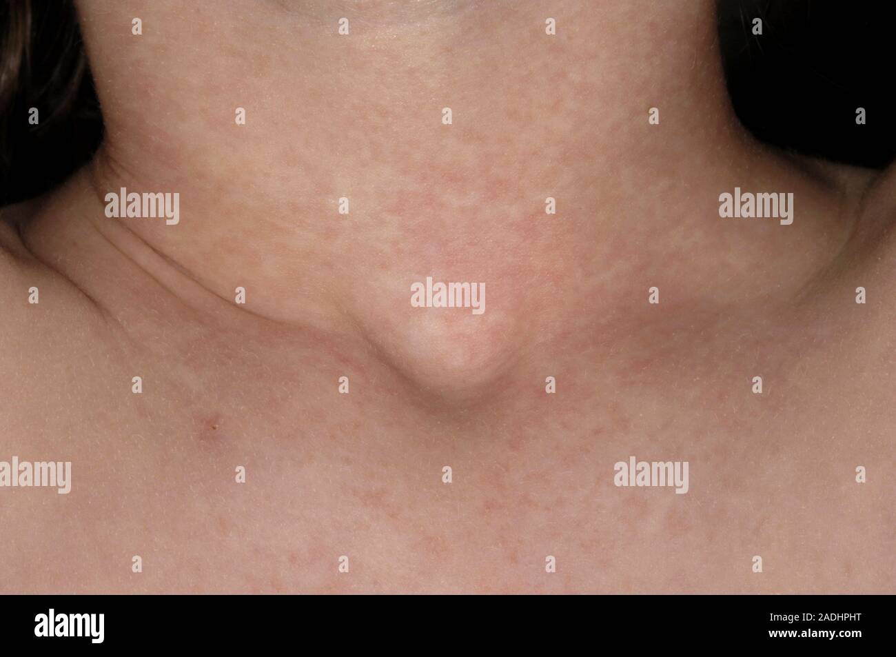 Scarlet Fever Rash On The Neck Of A 5 Year Old Girl Scarlet Fever Or Scarlatina Is A Disease
