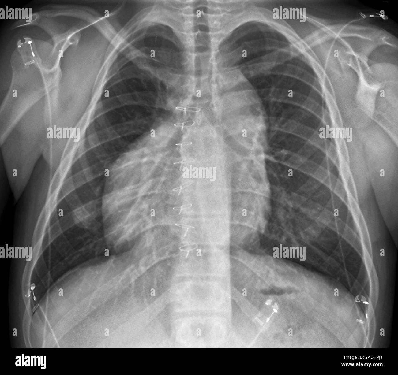 Reversed organs. Frontal X-ray of a 17-year-old patient with situs ...