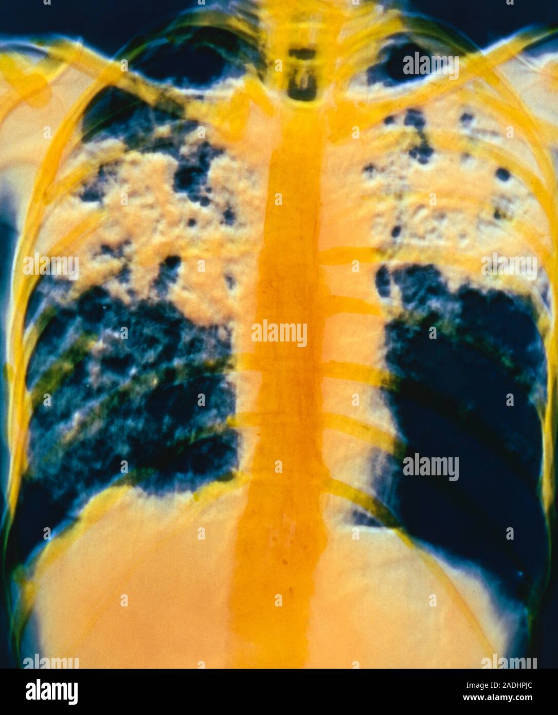 False colour human chest x-ray showing evidence of tissue calcification ...