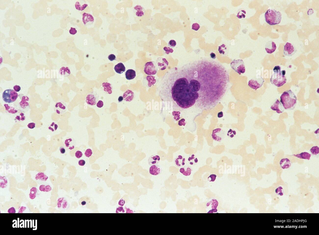 Light micrograph of a bone marrow film from a person suffering from ...