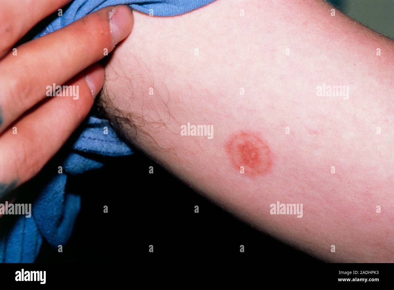 Example of tinea, also known as ringworm, on the arm of a sheepworker ...