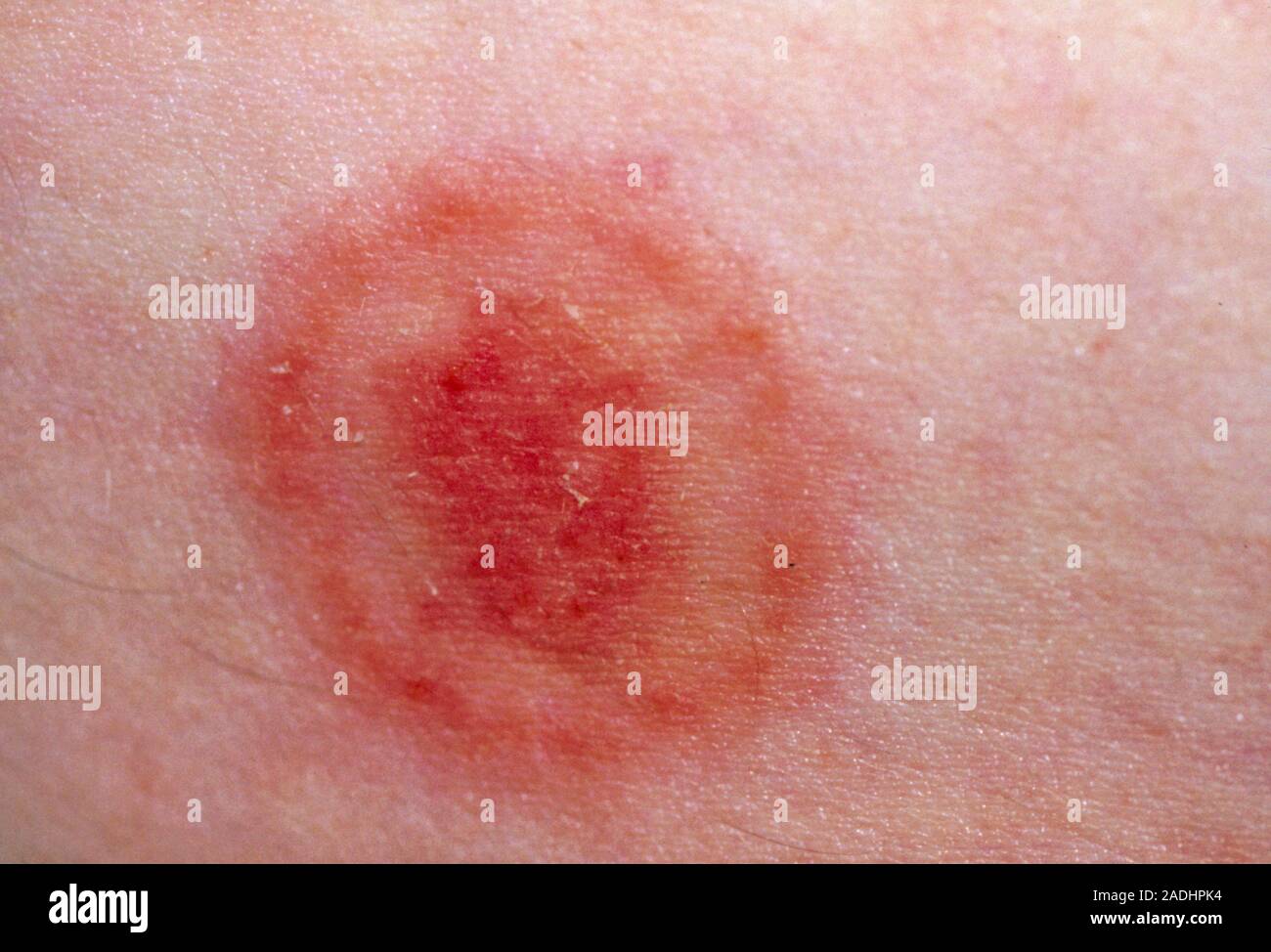 Example of tinea, also known as ringworm, on the arm of a sheepworker ...