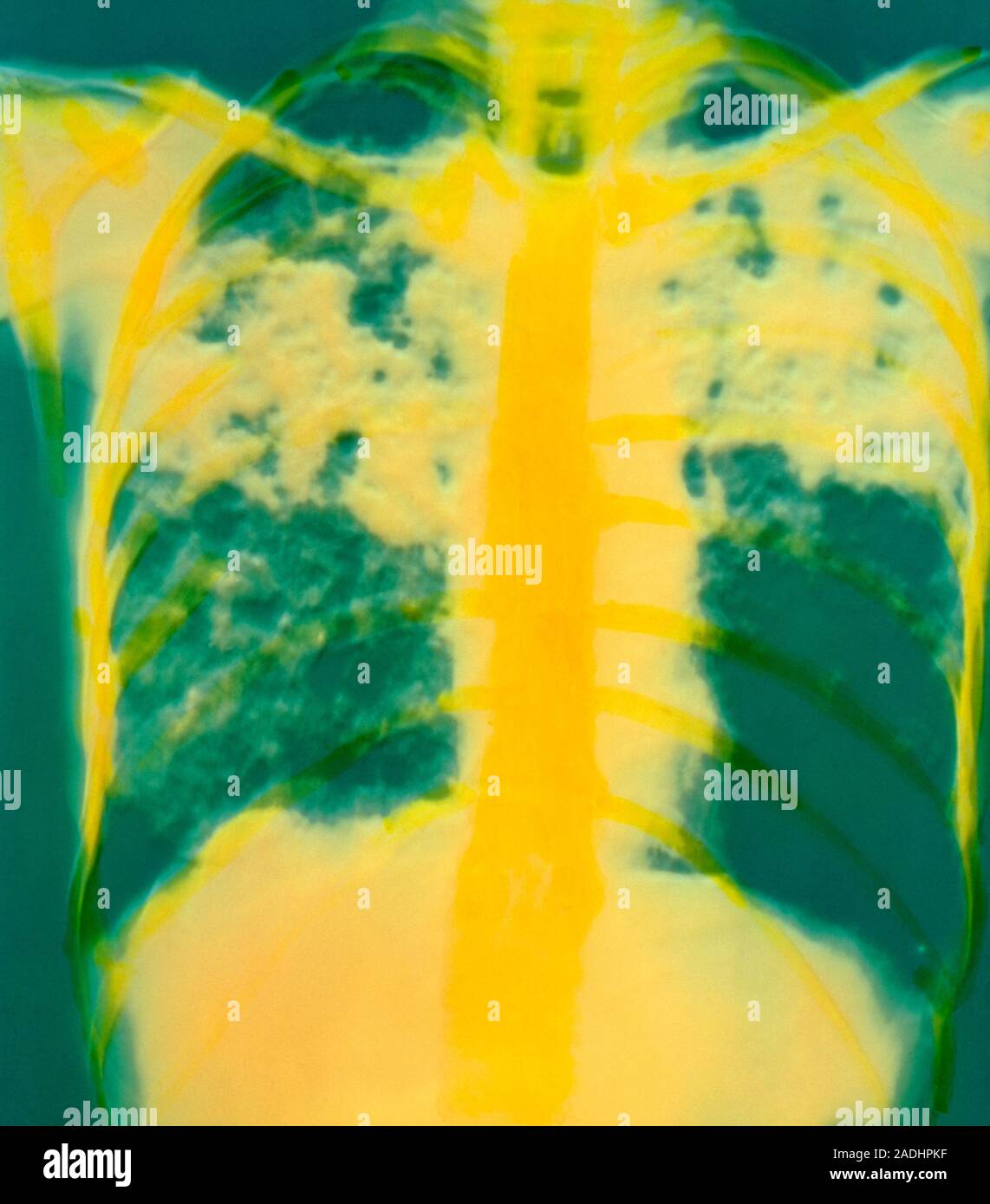 False colour human chest x-ray showing evidence of tissue calcification ...