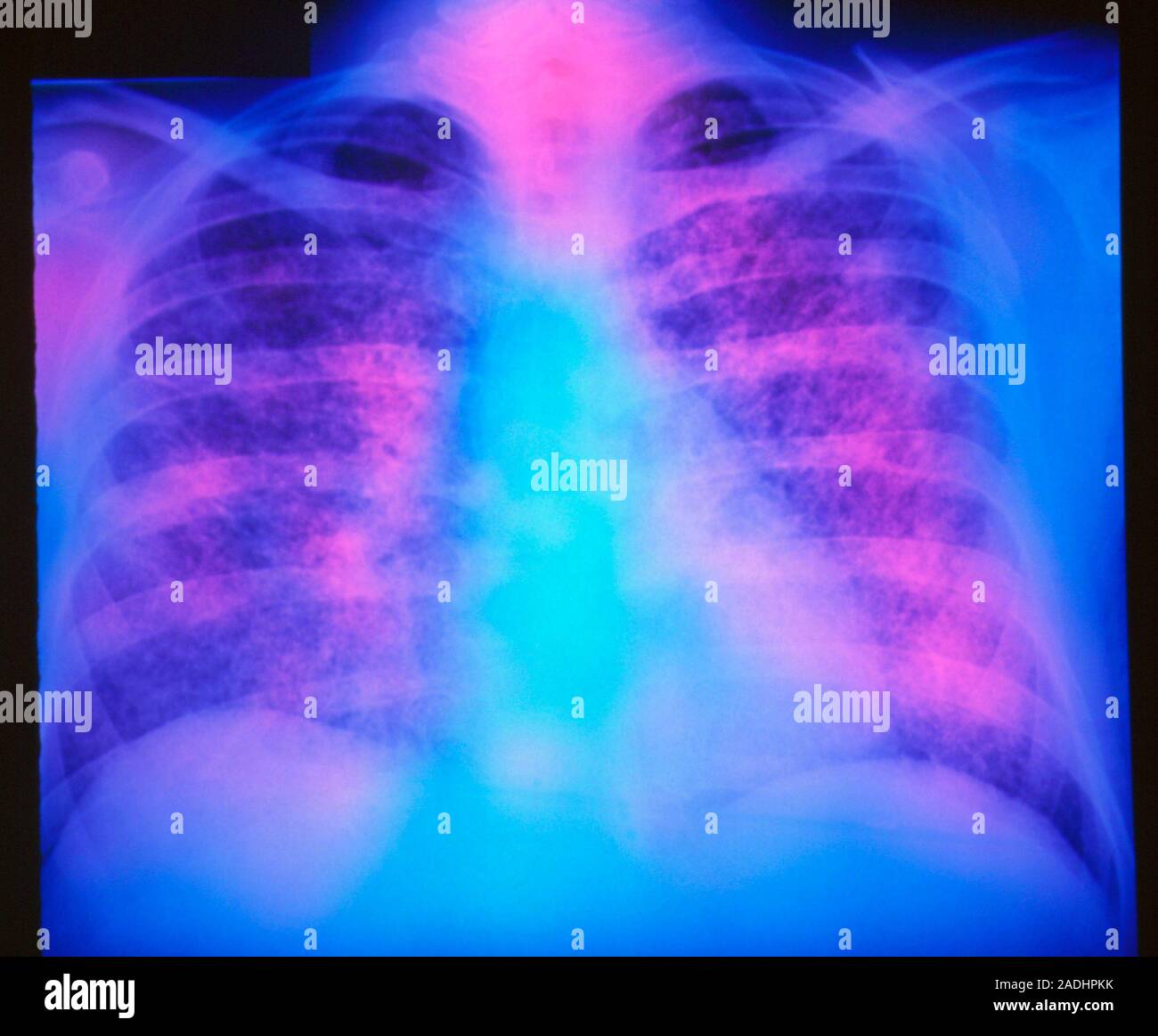 Miliary pulmonary tuberculosis. False-colour chest X-ray showing fine ...