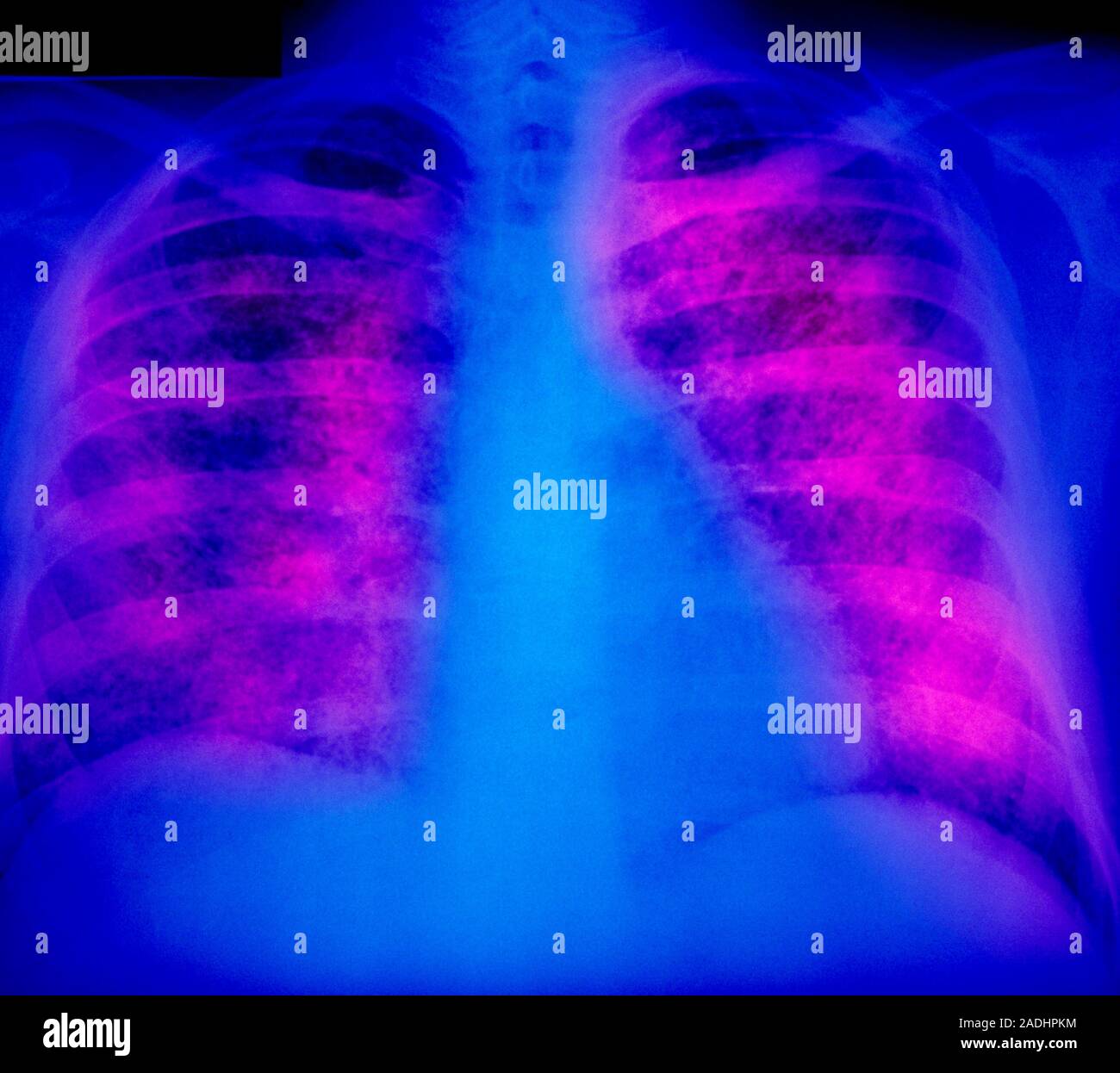Miliary pulmonary tuberculosis. False-colour chest X-ray showing fine ...