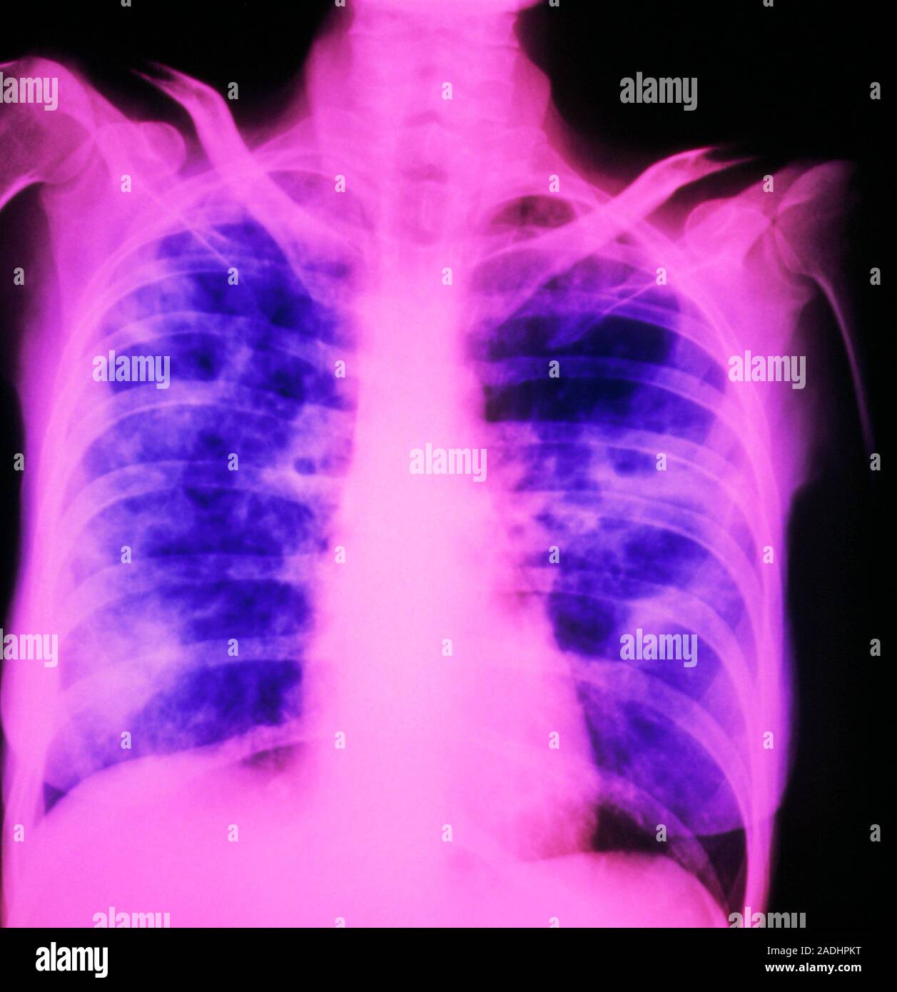 Post-primary cavitating tuberculosis. False-colour Chest X-ray showing ...