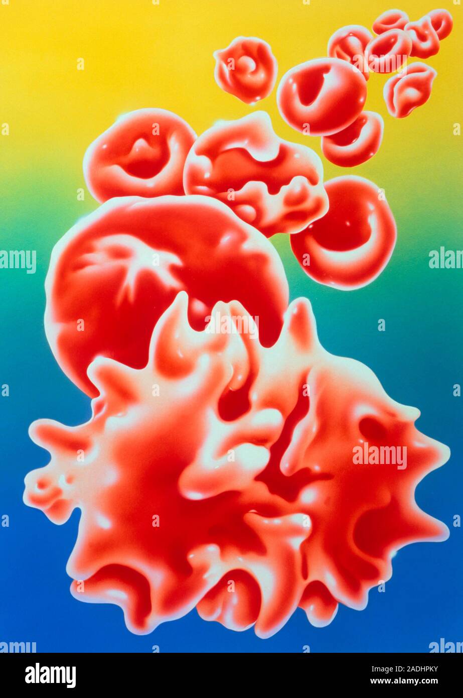 Thalassaemia. Illustration of distorted red blood cells in the ...