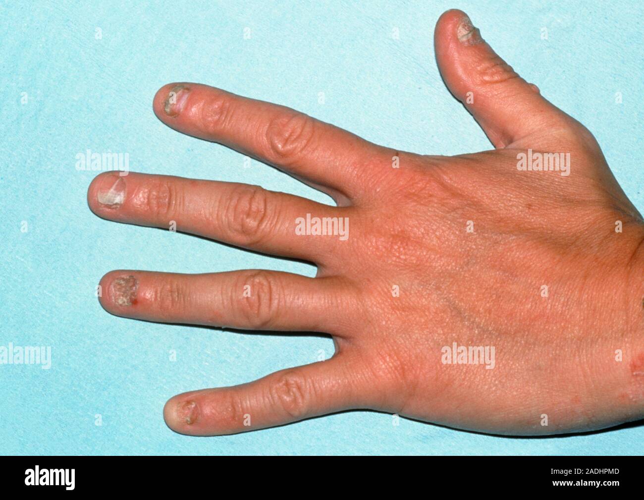 Fungal infection (tinea). View of broken & poorly growing fingernails ...