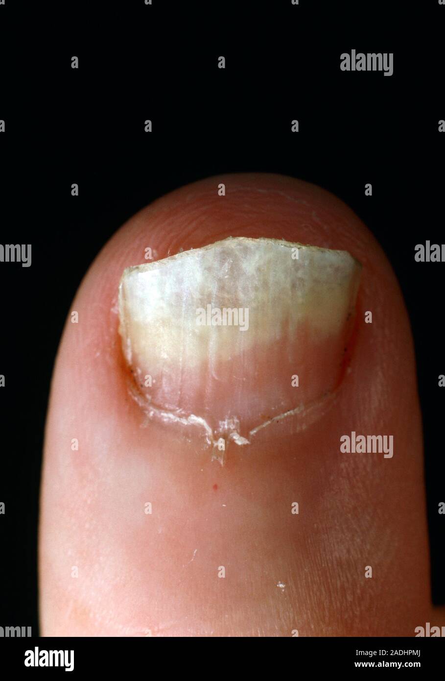 Fungal infection (tinea). Fingernail damaged by a fungal infection ...