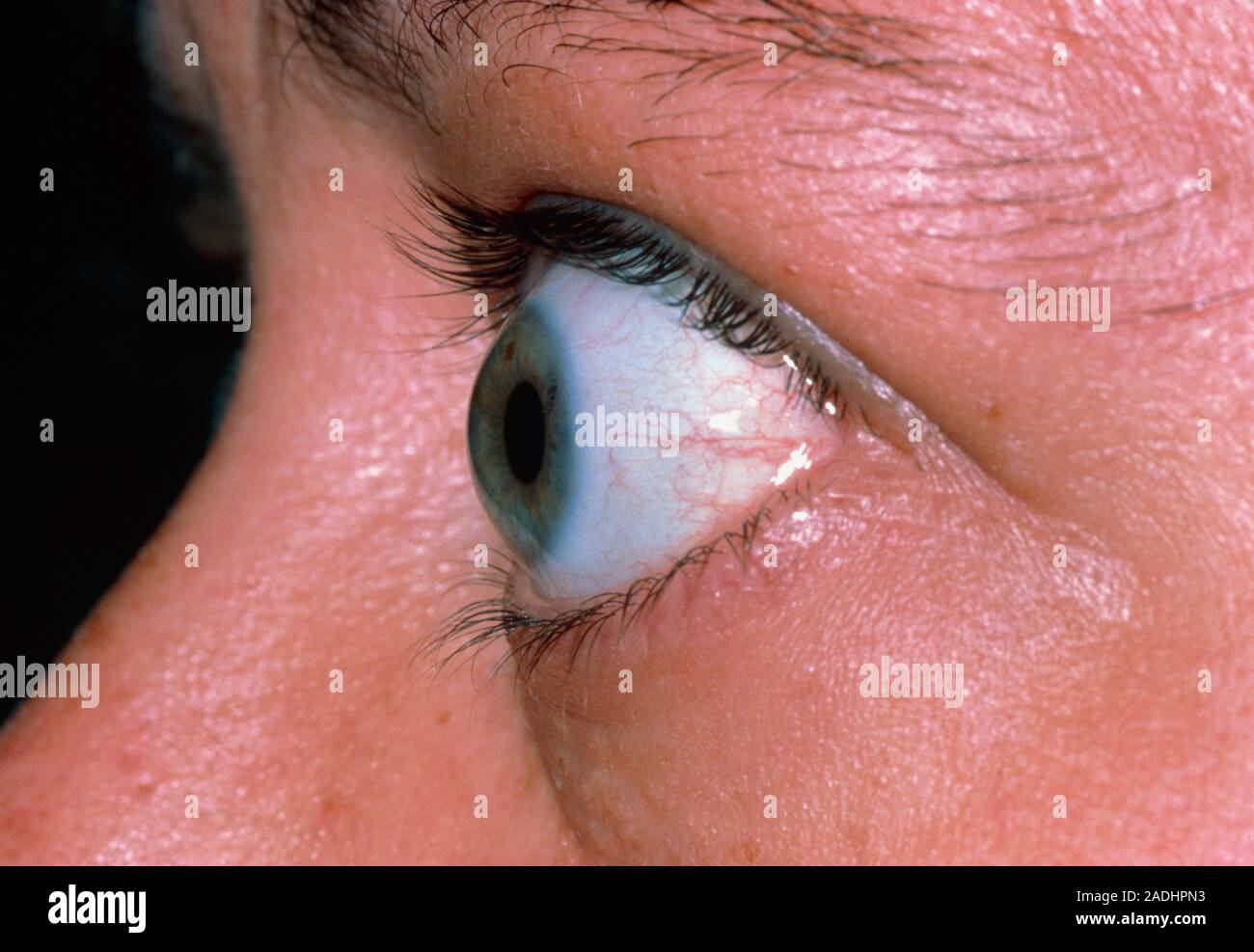 Eye in thyrotoxicosis. Side view of the bulging eye (exophthalmos) of a ...