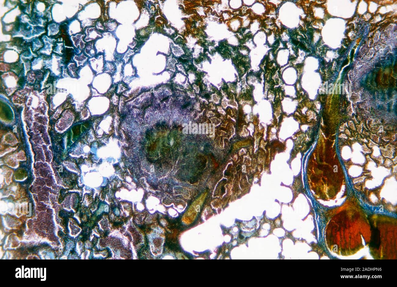 Miliary tuberculosis. Light micrograph of human lung tissue damaged by ...