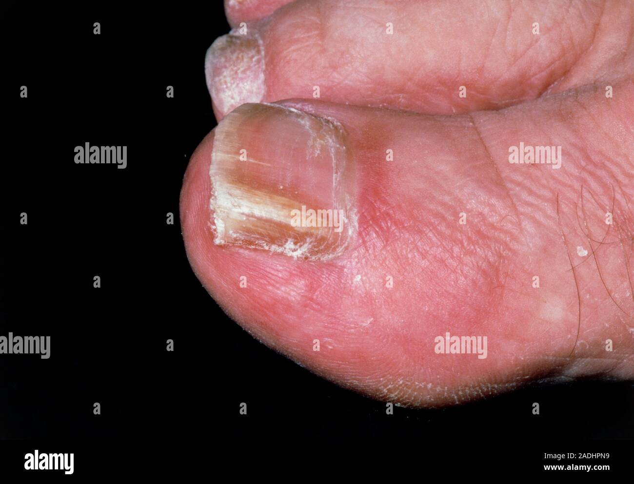Tinea unguium. Close-up of toenails infected with the fungus ...