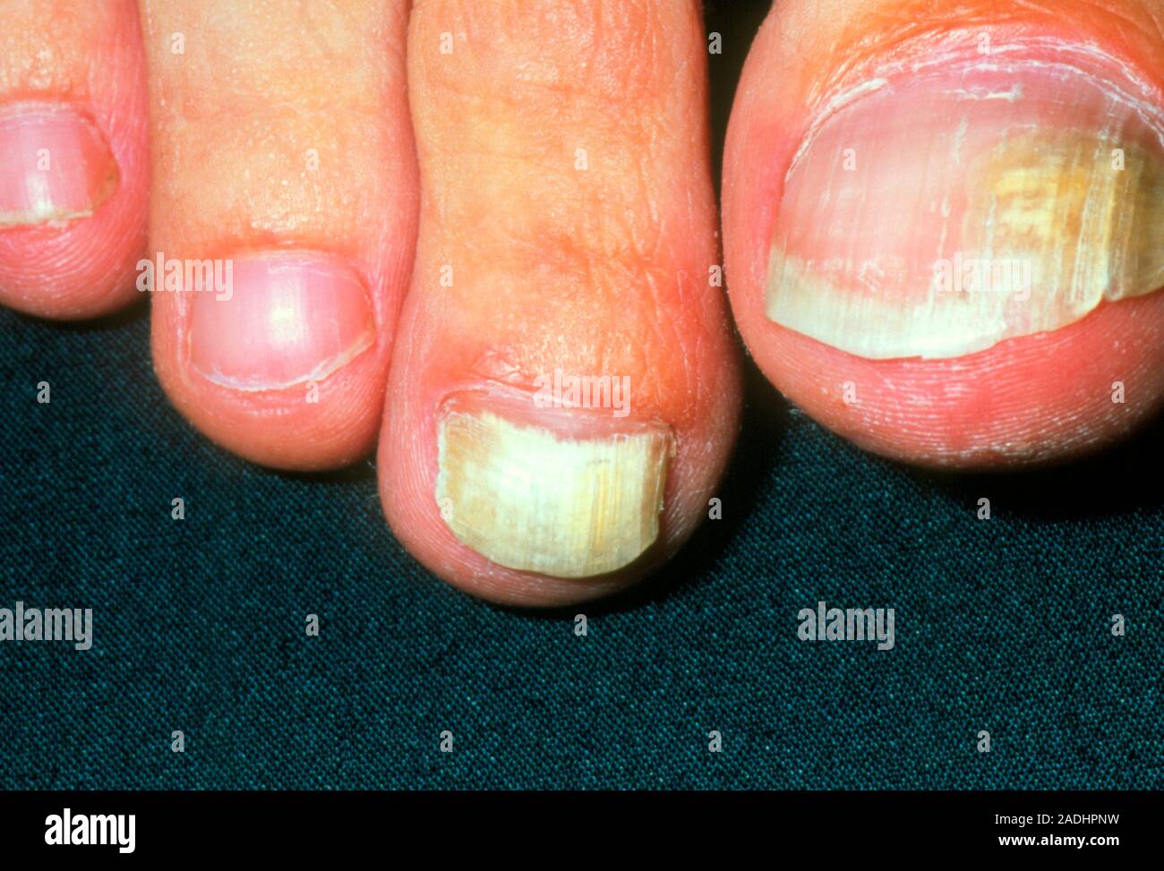 Tinea unguium toenail infection. View of broken, discoloured and poorly ...