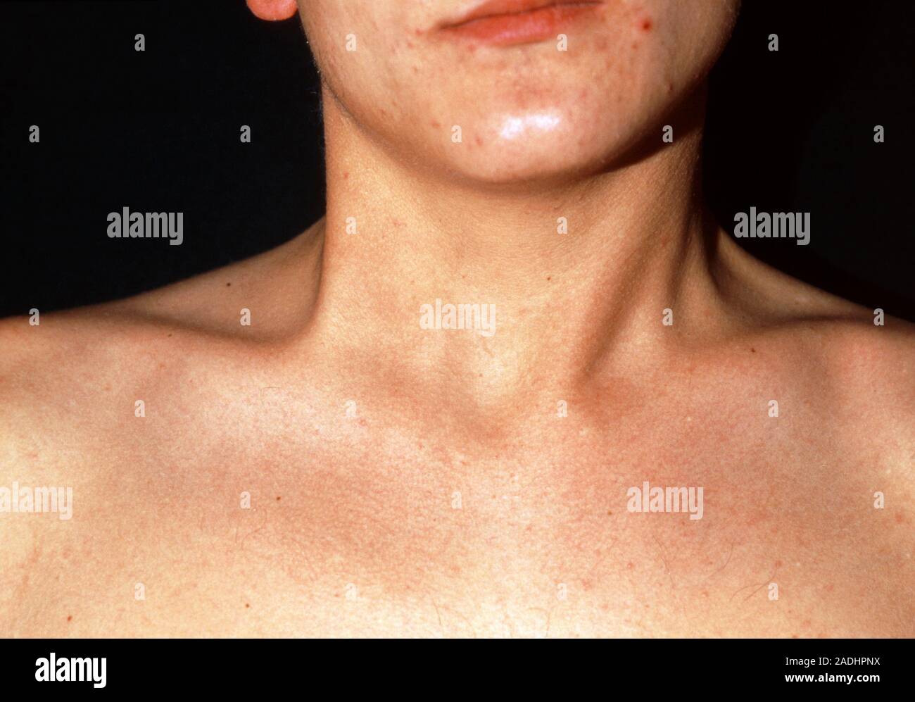 Torticollis. View of the neck of a 20 year old man showing a twisted ...