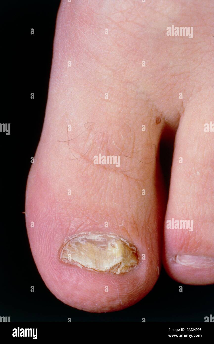 Fungal infection. View of the broken, discoloured and poorly growing ...