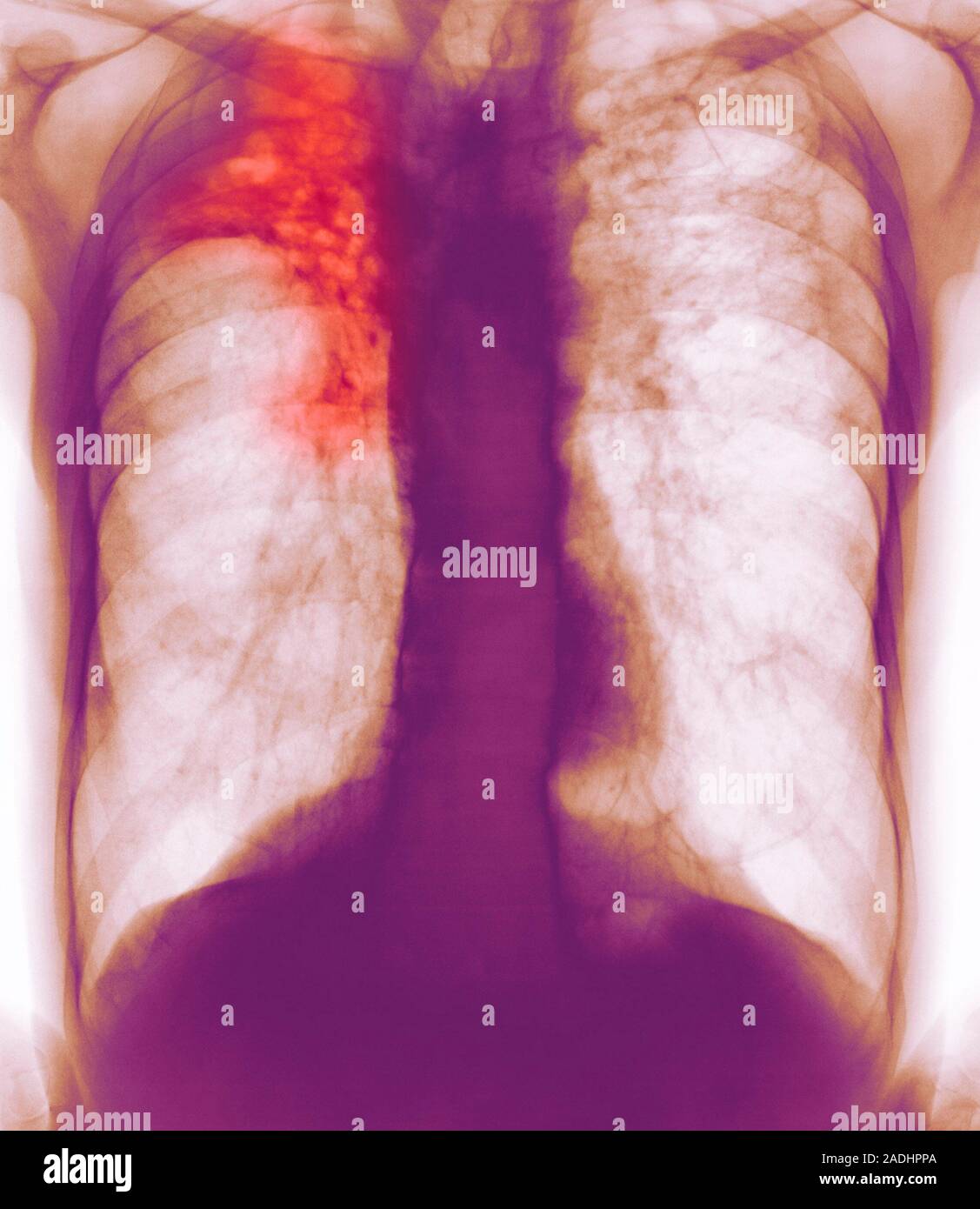 Tuberculosis. Coloured chest X-ray of a man with active pulmonary ...