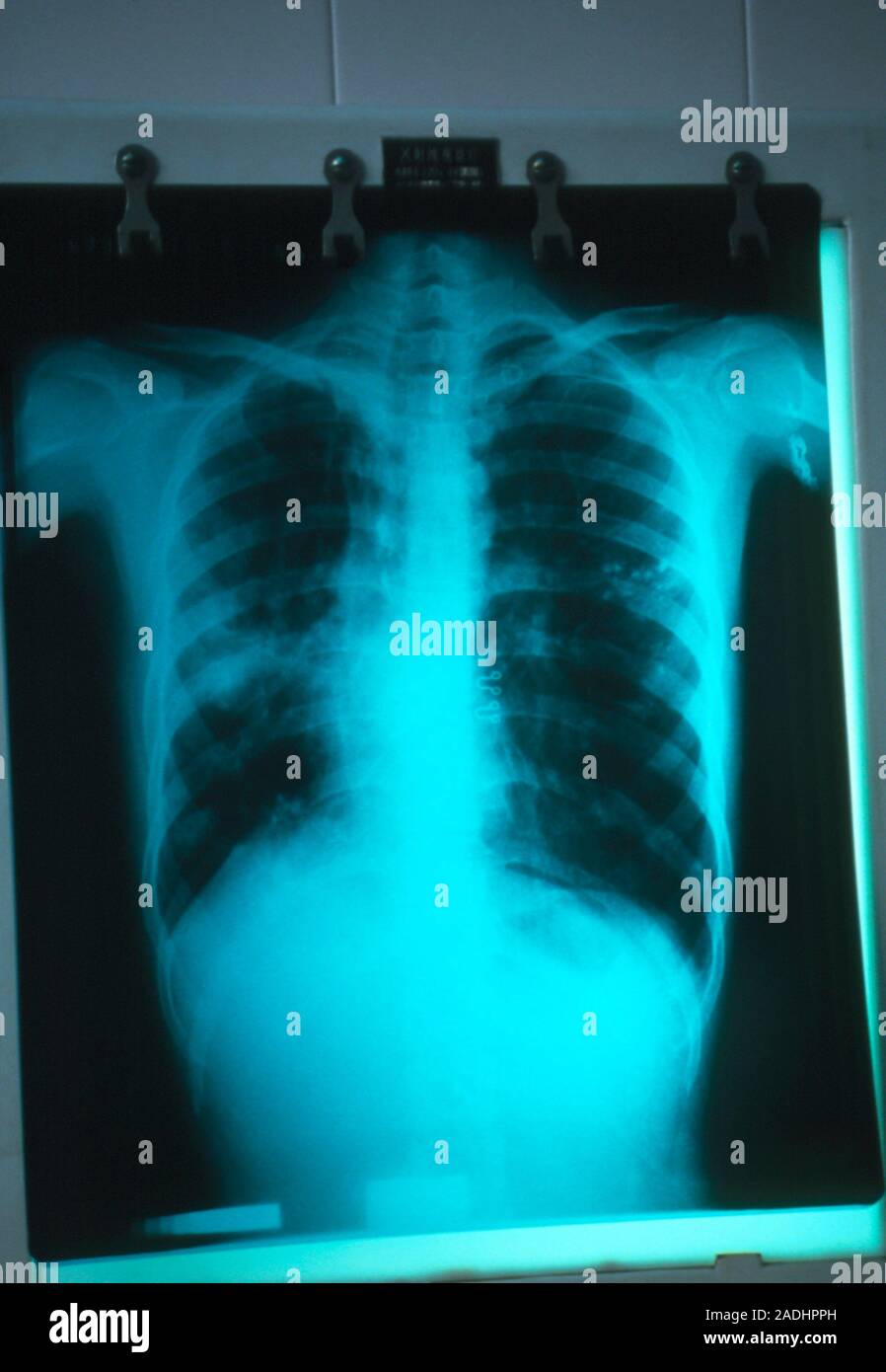 Pulmonary tuberculosis. Chest X-ray of a male patient with pulmonary ...