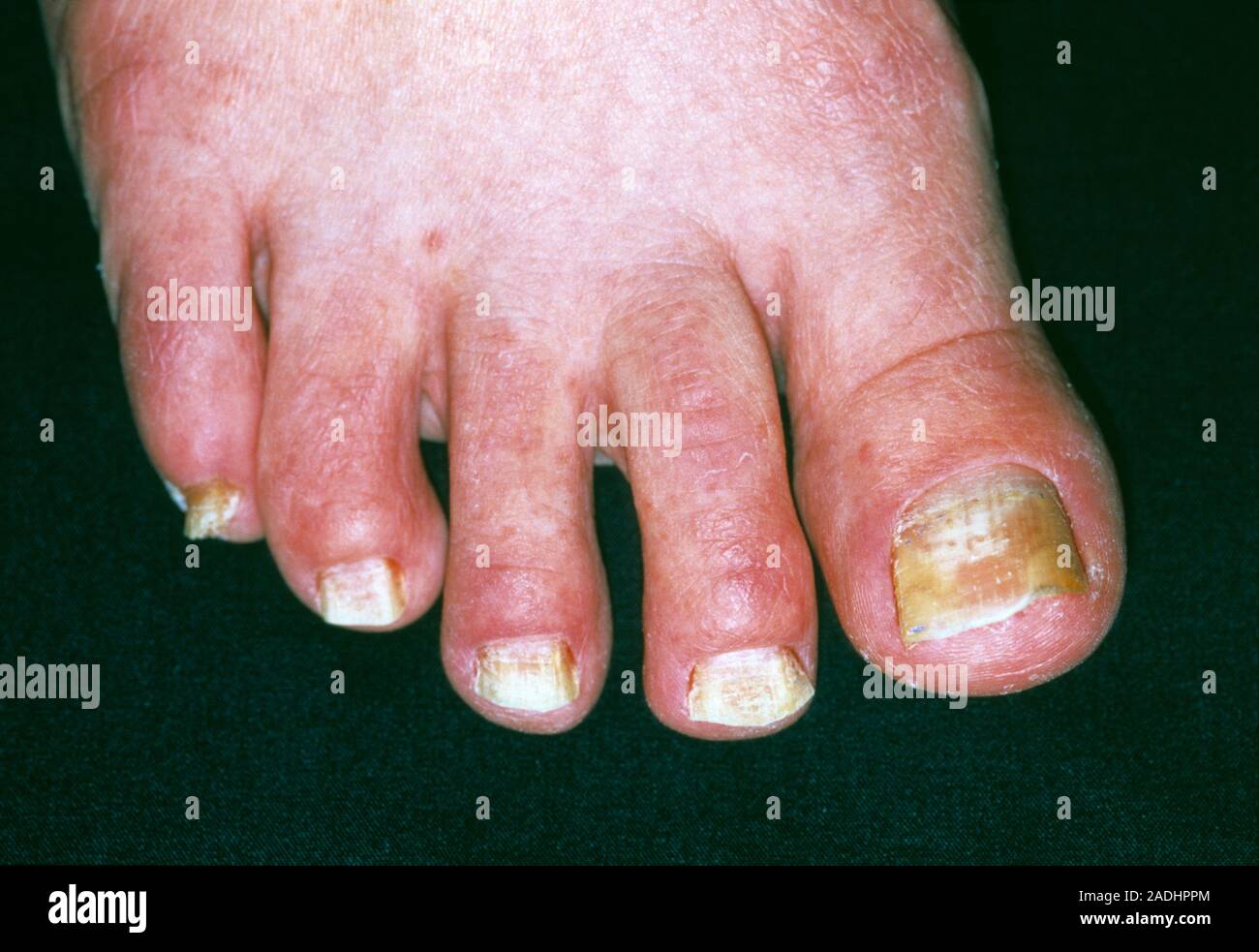 Fungal infection (ringworm) of the toenail of a 36 year old woman. The affected nail has become ...
