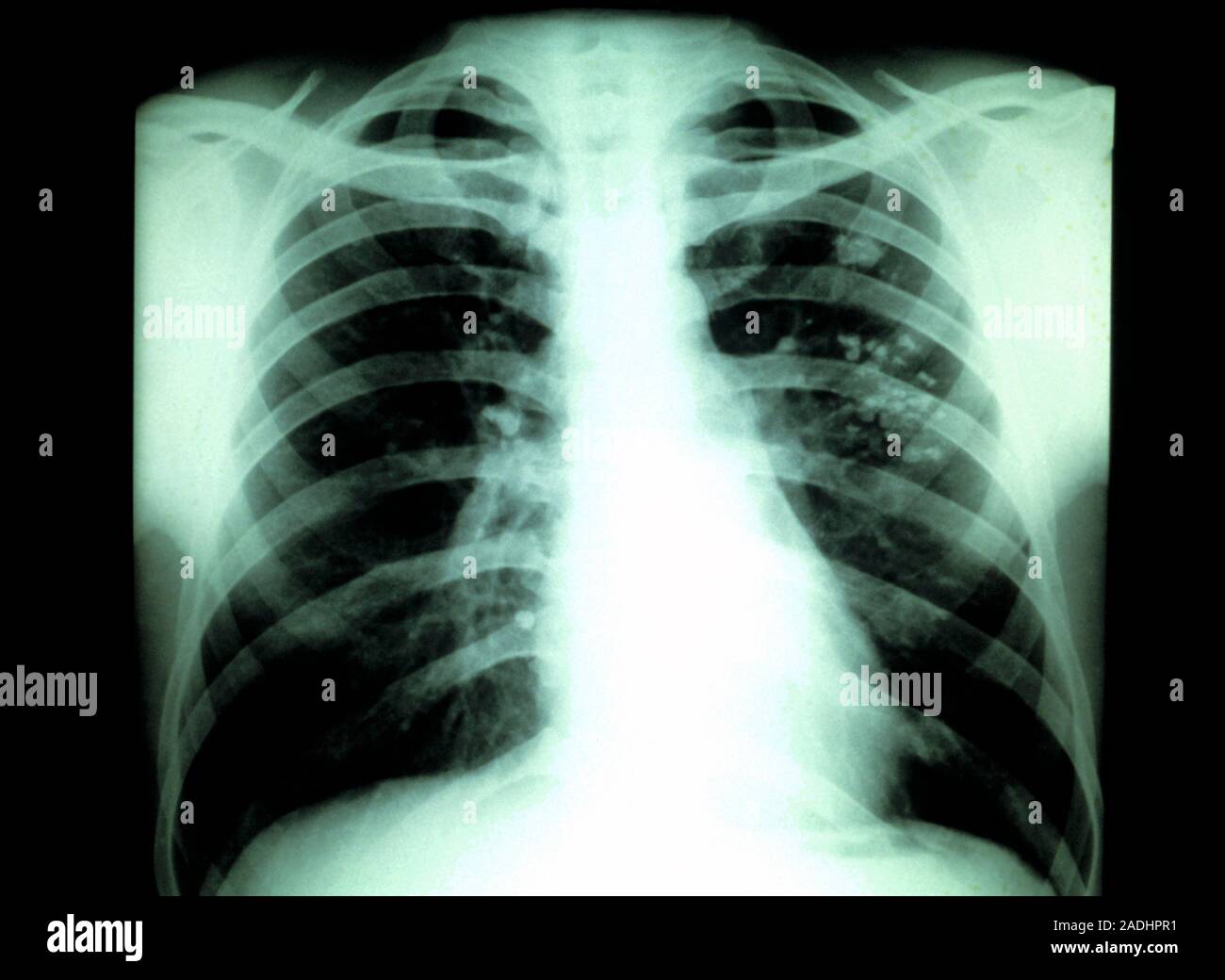 Pulmonary tuberculosis. X-ray of the chest of a patient after recovery ...