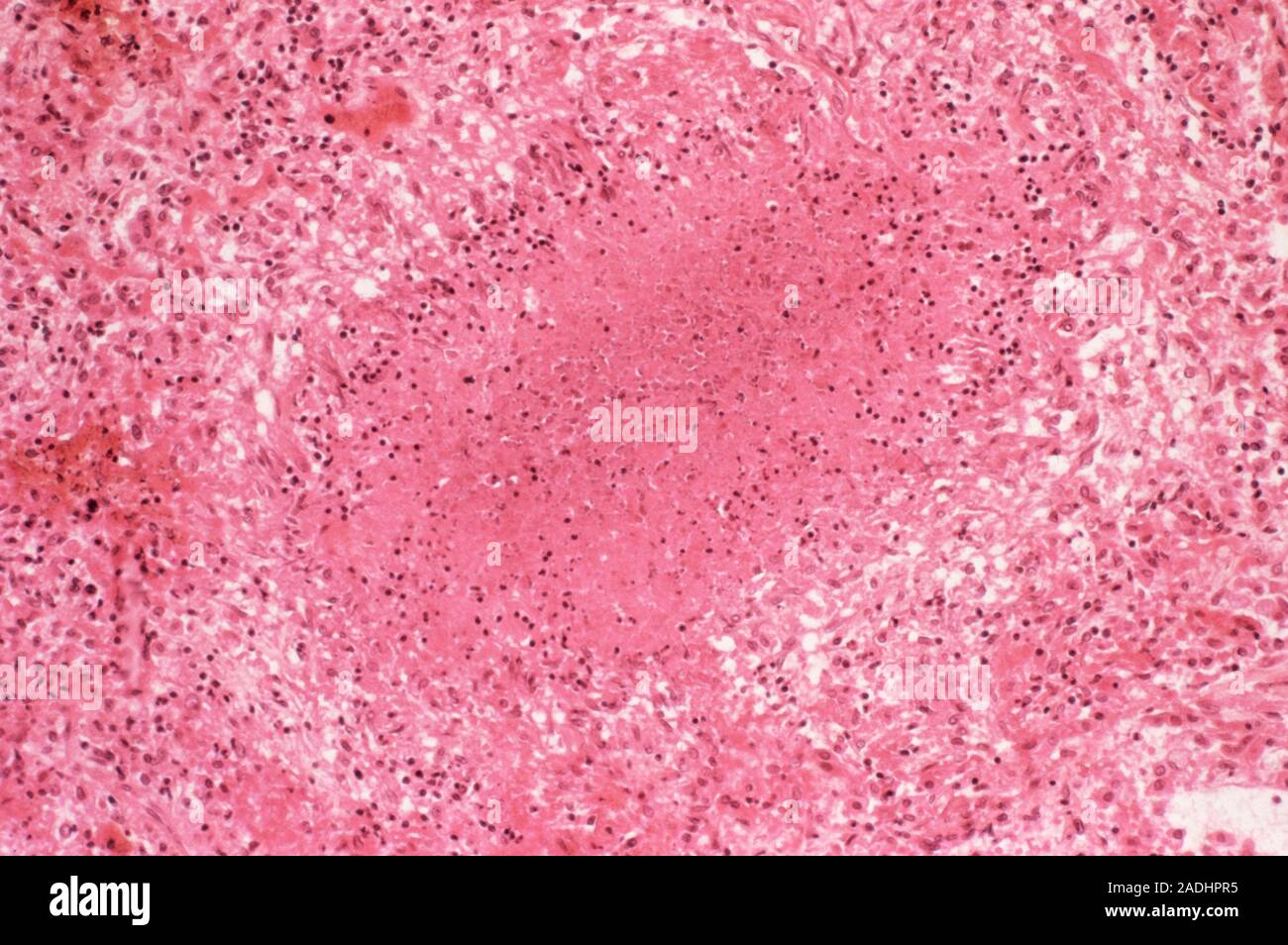Tuberculosis. Light micrograph of a section through lung tissue showing ...