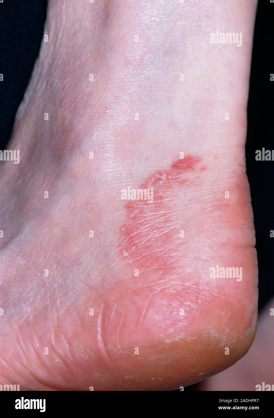Athlete's foot infection. Heel of a 52-year-old woman with the fungal ...