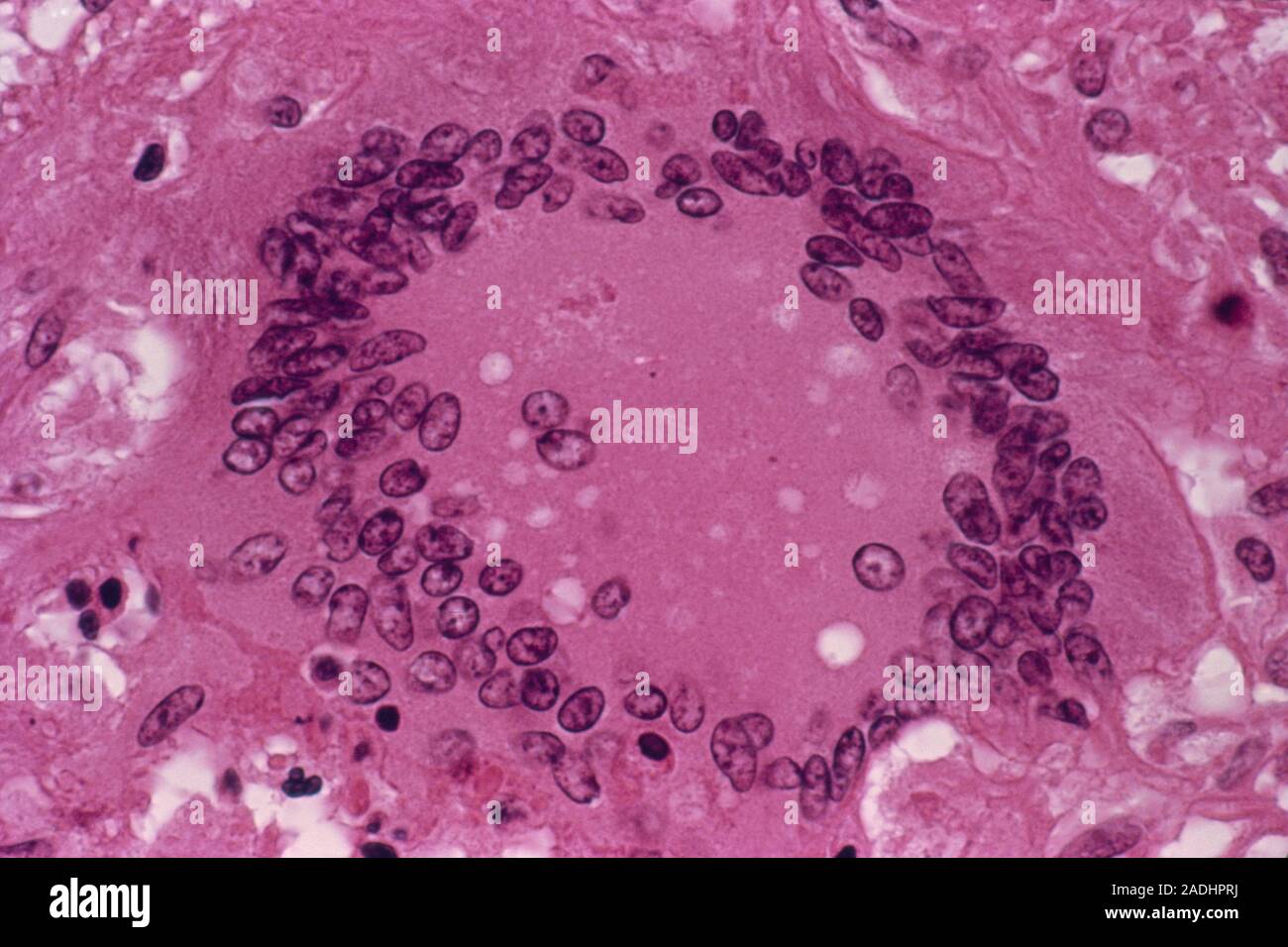 Tuberculosis. Light micrograph of a section through a lymph node ...