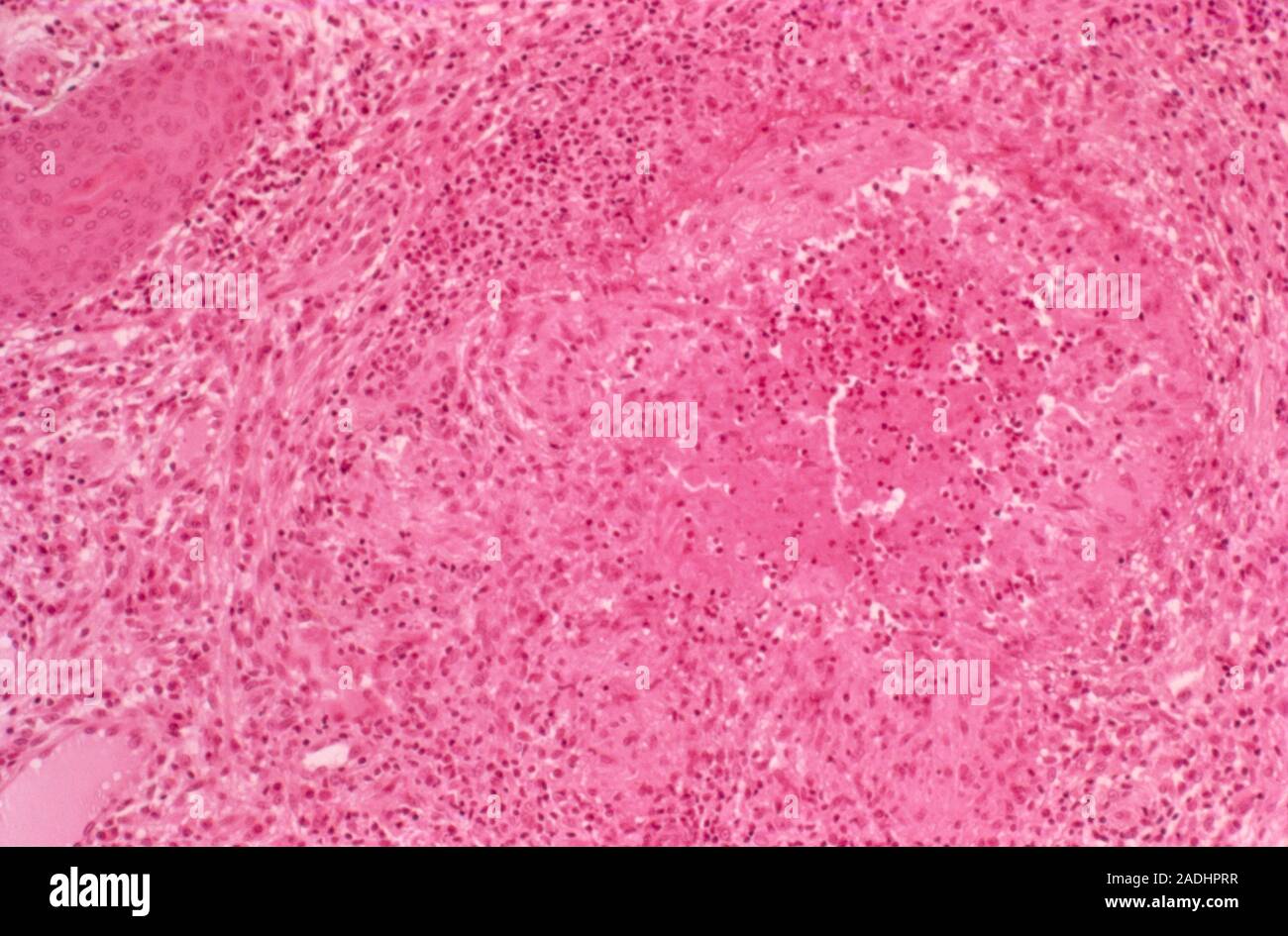 Skin lesion. Light micrograph of a section through a tuberculosis skin ...