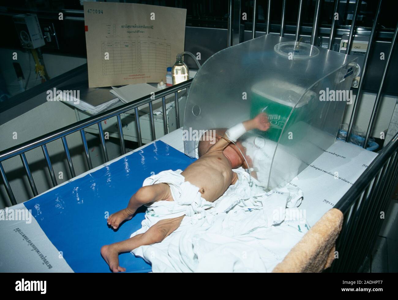 Tuberculosis. Baby with drug-resistant pulmonary tuberculosis (TB ...