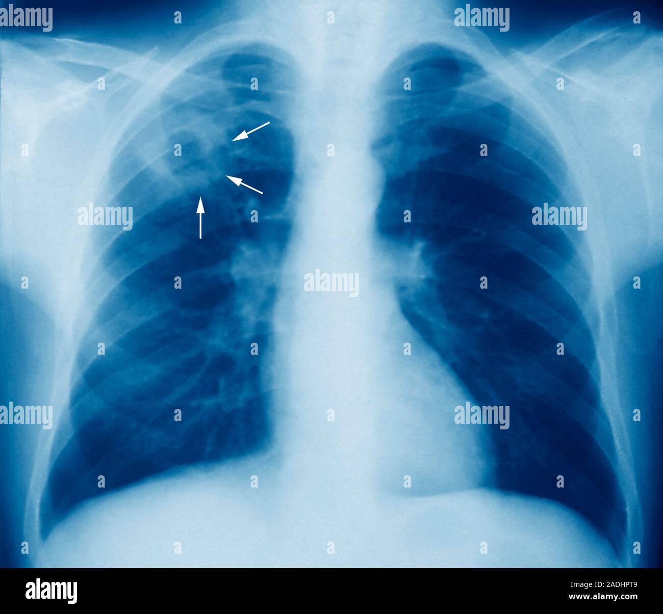 Tuberculosis. Coloured frontal X-ray of the chest of a patient ...