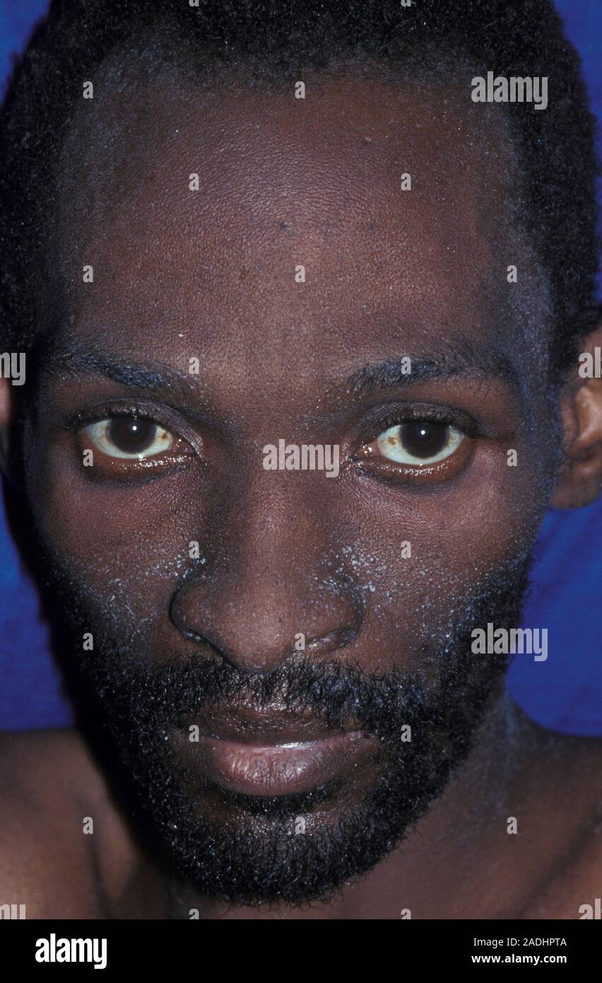 MODEL RELEASED. Renal tuberculosis. Uric acid crystals on a man's face ...